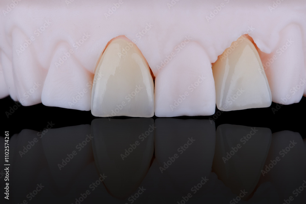 High-quality naturally dental single crowns made of zirconium for ...