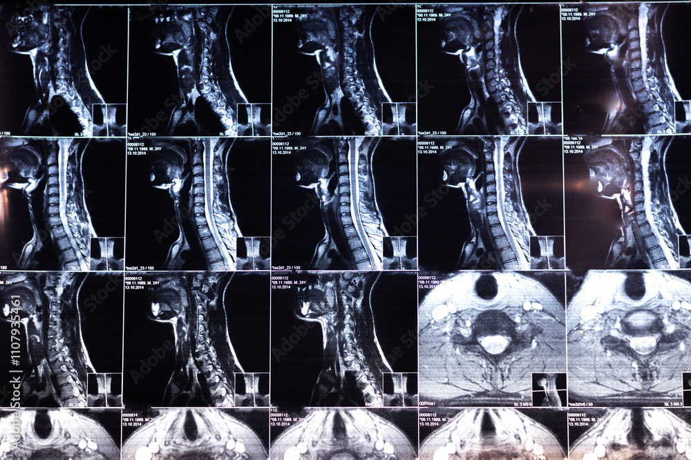 MRI neck spine. X-ray scan..Spondylosis of the cervical spine ...