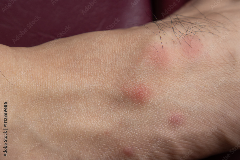 The blisters are red and itchy on the patient's skin that are caused by ...