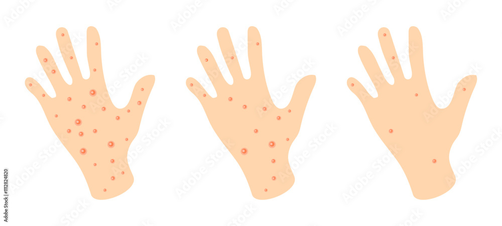 Visual representation of skin conditions showing hands with varying ...