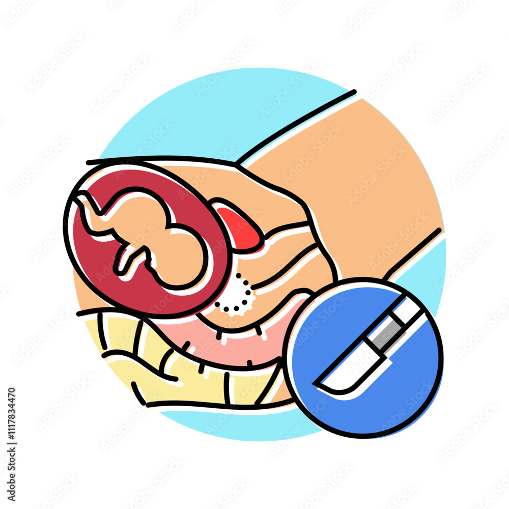 cervical cerclage surgery color icon vector. cervical cerclage surgery ...