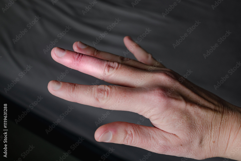 Foto de Stock Mallet finger healing after splint removal from middle ...