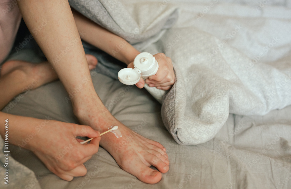 Close up of Child's legs with many red spot. A sick child with skin ...