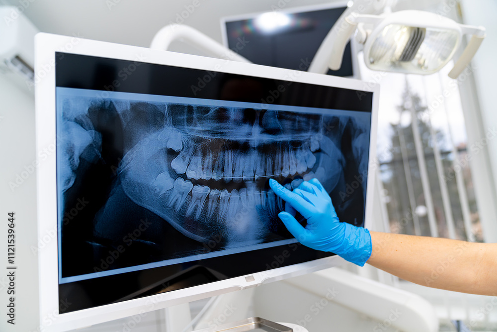 Dentist reviewing dental x-ray on computer screen. A dentist inspects a ...