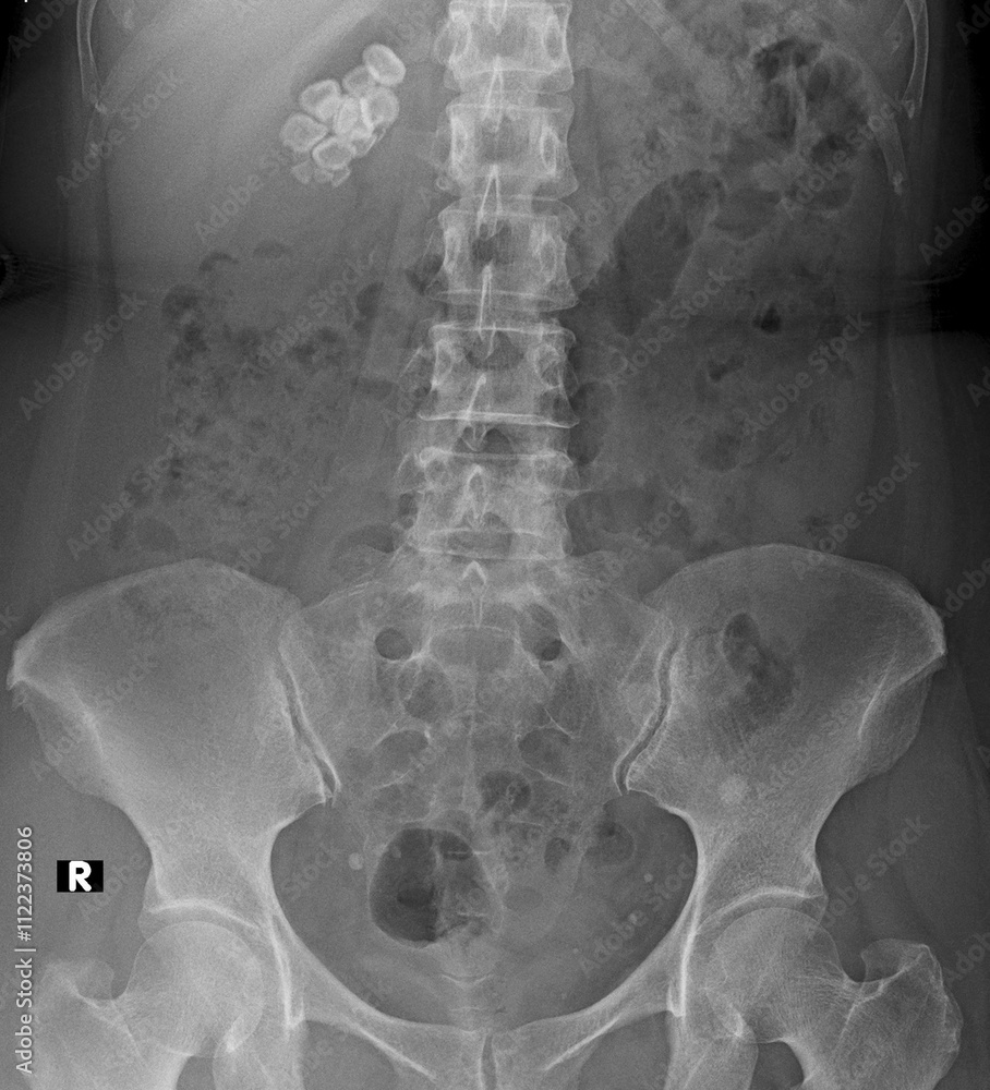 Cholelithiasis,Gall Bladder Stones xray image radiology Stock Photo ...