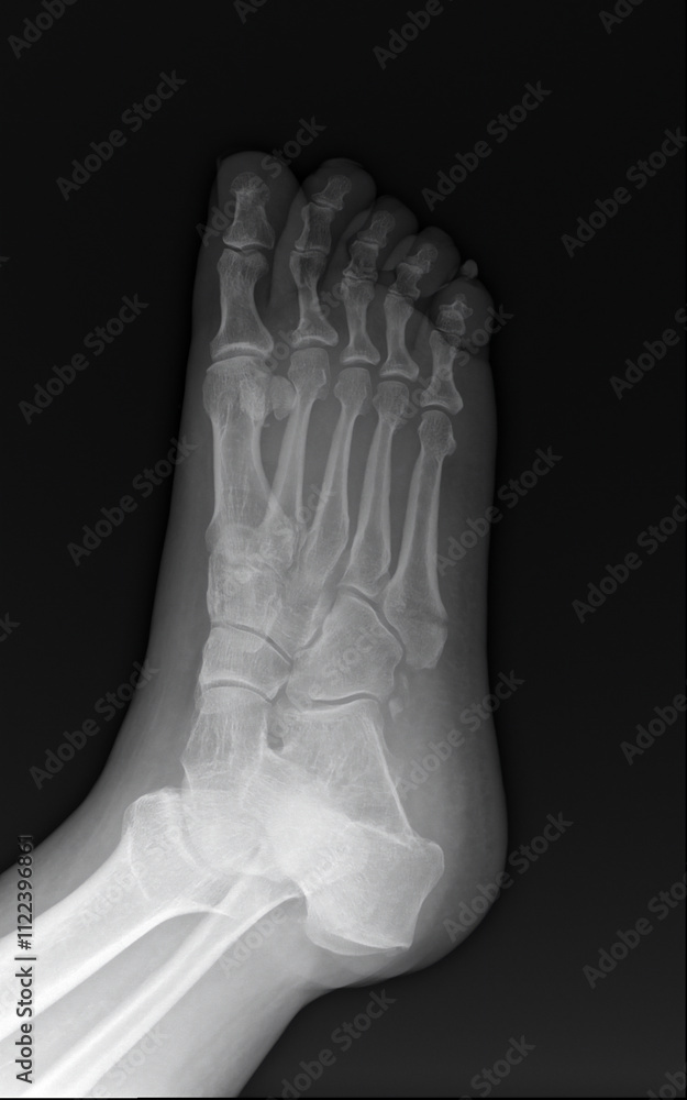 x-ray of foot fractured metatarsal bone. roken foot, oblique view, show ...