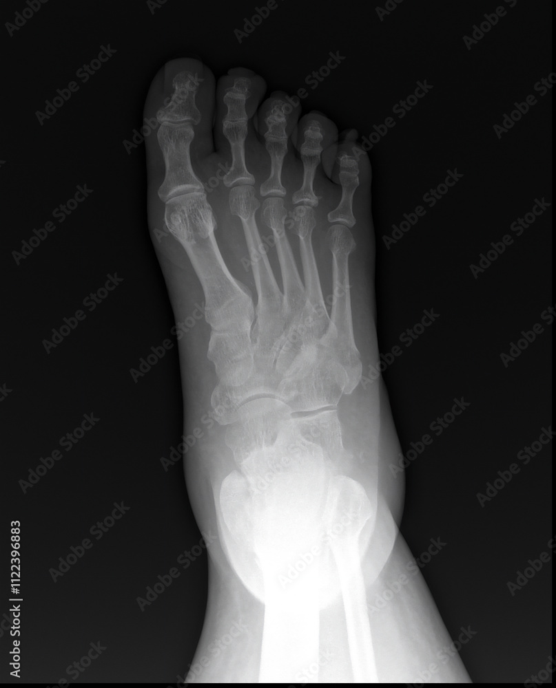 x-ray of foot fractured metatarsal bone. roken foot, oblique view, show ...
