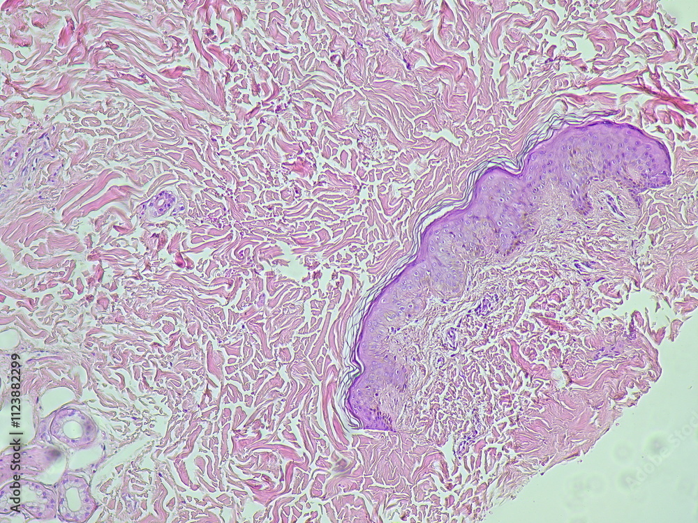 tumor regio thoracalis posterior, microscopic image of a dermatofibroma ...
