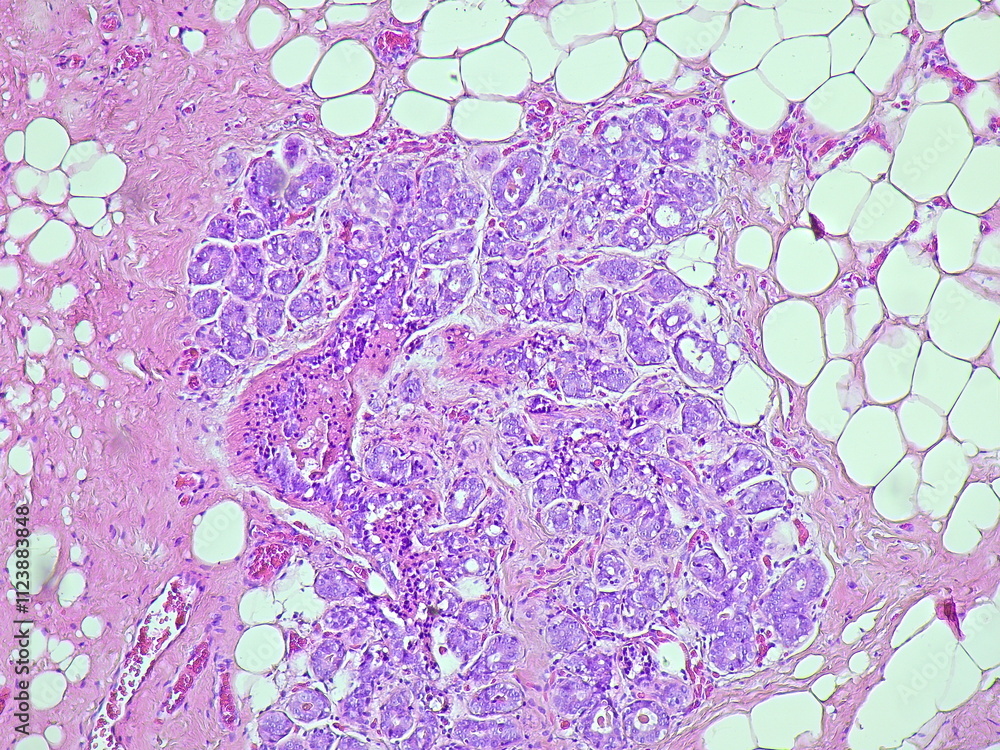 Human breast cell tissue under a microscope in a pathology laboratory ...