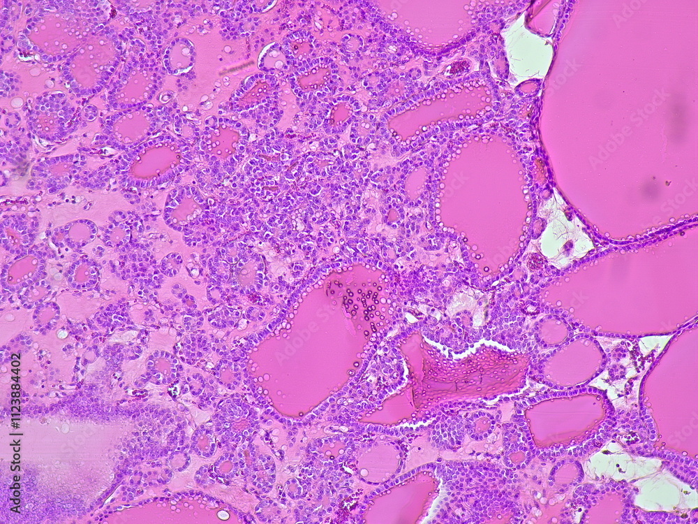 Photomicrograph showing histology of benign thyroid nodule under ...