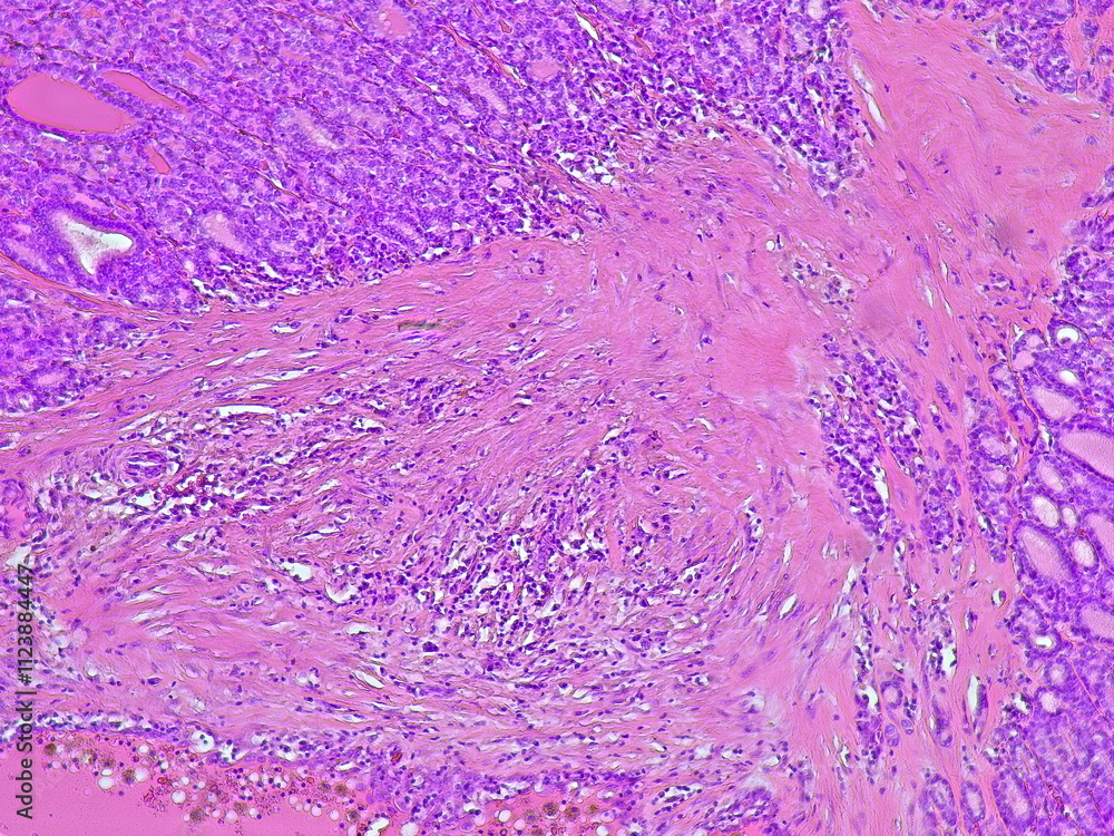 Photomicrograph showing histology of benign thyroid nodule under ...