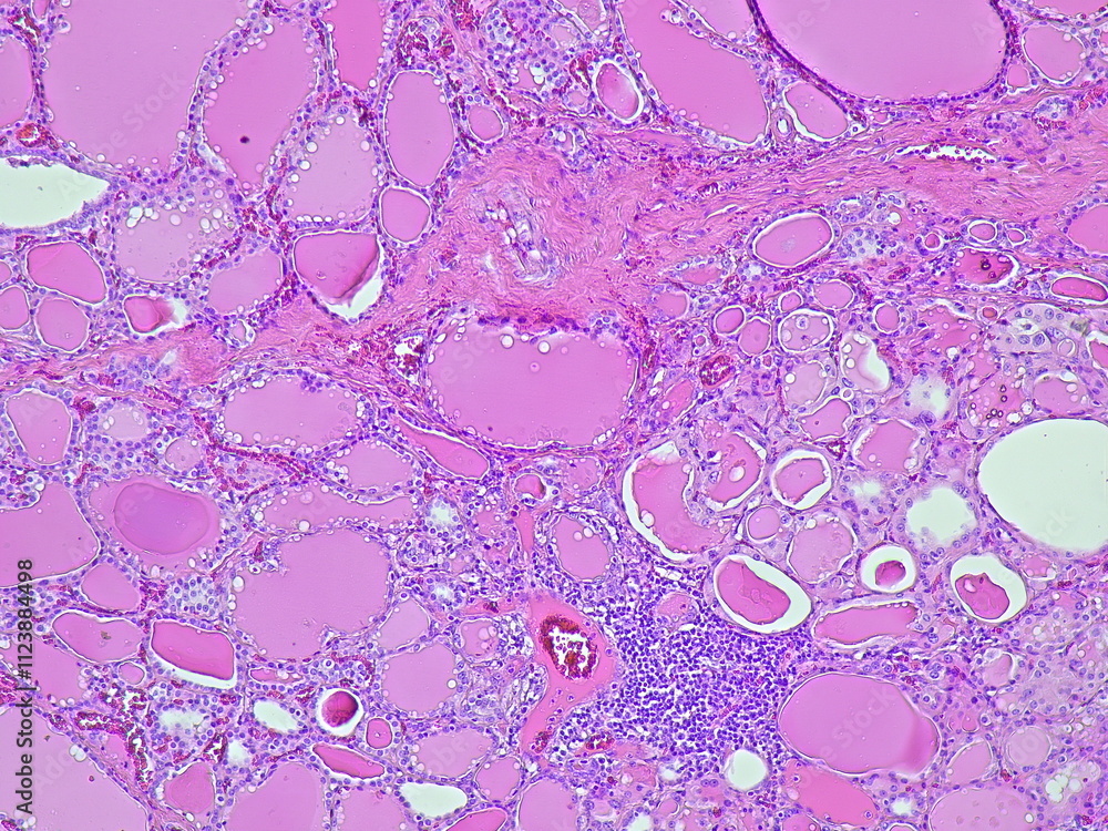 photomicrograph of Hashimoto's thyroiditis (chronic lymphocytic ...