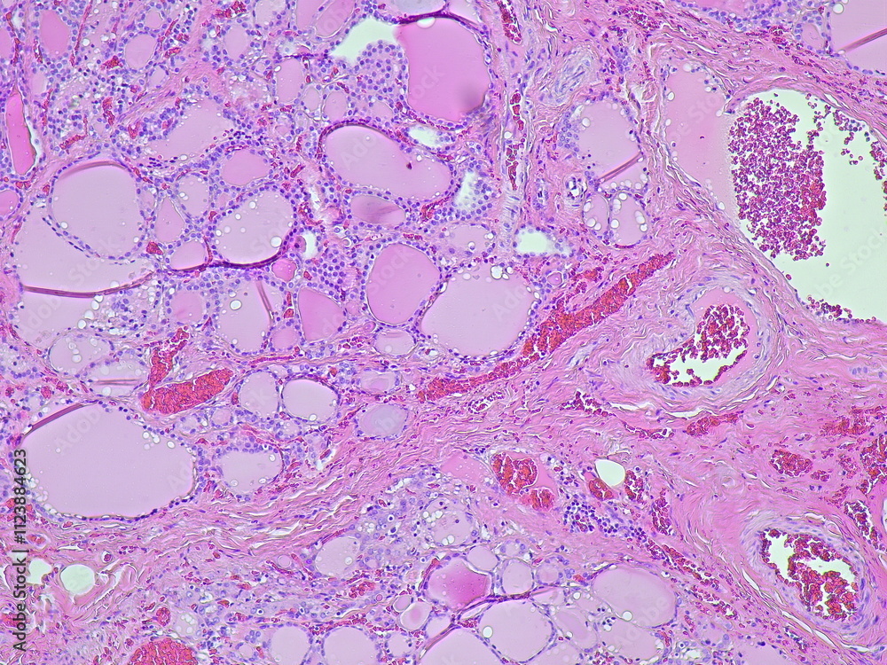 photomicrograph of Hashimoto's thyroiditis (chronic lymphocytic ...