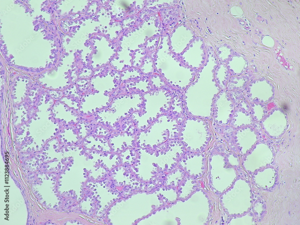 photomicrograph Histology of a breast biopsy from a pregnant woman ...