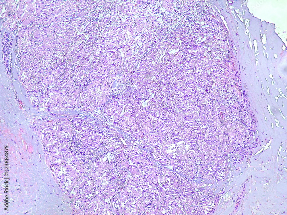 photomicrograph Histology of a breast biopsy from a pregnant woman ...