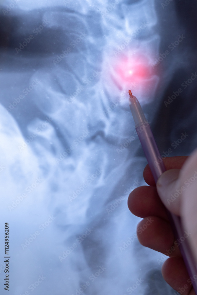 Vertical image of X-rays for Diagnosing Whiplash Injuries of Cervical ...