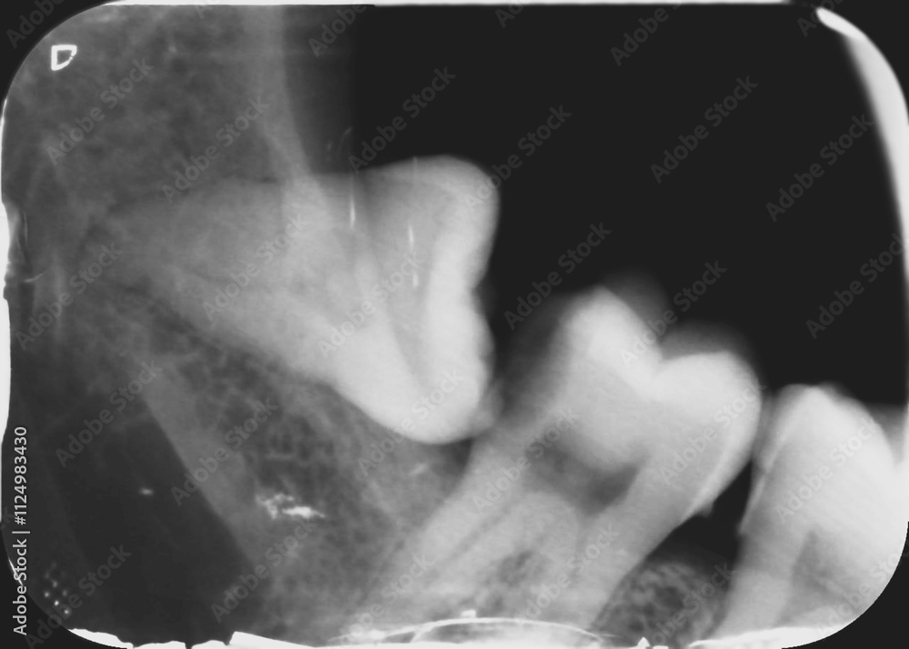 Periapical x-ray showing malposition of right lower wisdom tooth and caries on a second ...