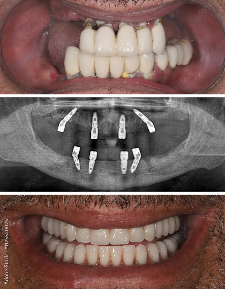 In dentistry, dental implant treatment involves placing a full arch ...