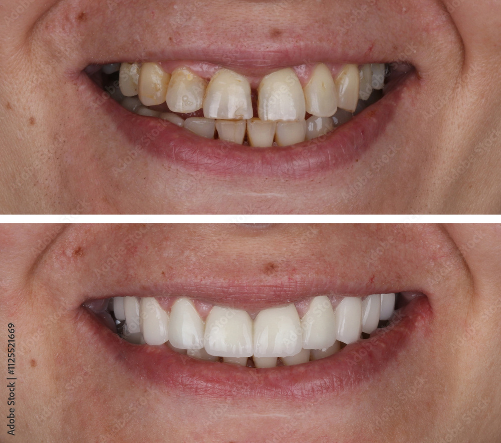 In dental aesthetic dentistry, smile design treatment with laminate ...