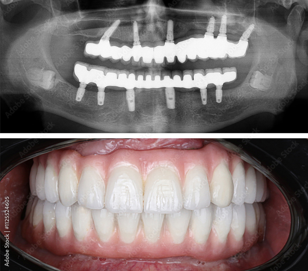 In dentistry, dental implant treatment involves placing a full arch ...