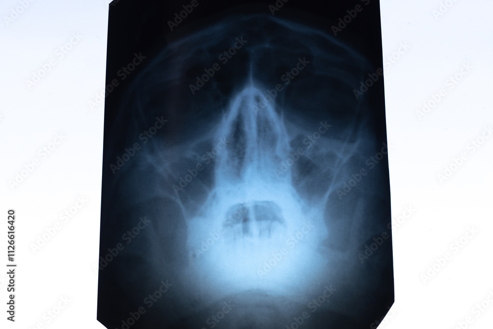 X-ray scan of a human skull. Deviated septum. Nasal septum, bone and ...