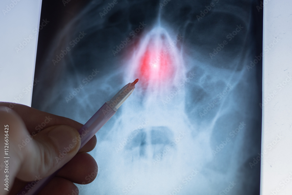 Doctor learning X-ray scan of a human skull. Deviated septum. Nasal ...