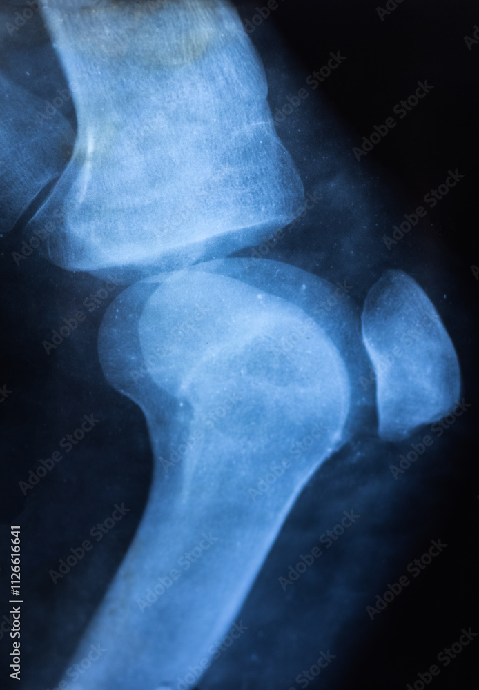 Vertical Knee joint x-ray. Diagnostic of Knee bone pathology, detected ...