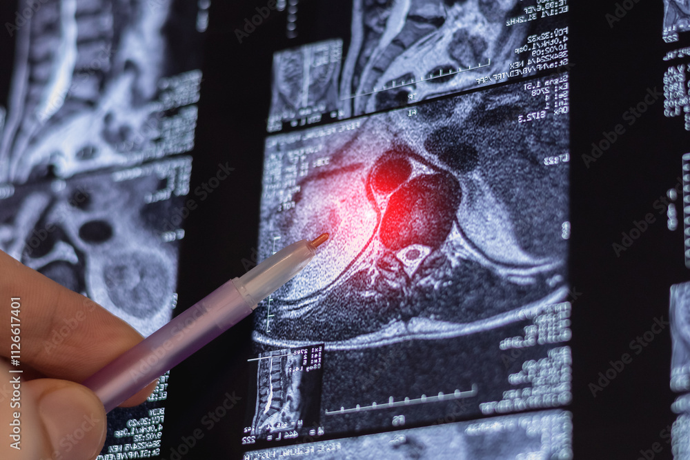 Doctor learn Magnetic resonance image of human spine. MRI of lumbar ...