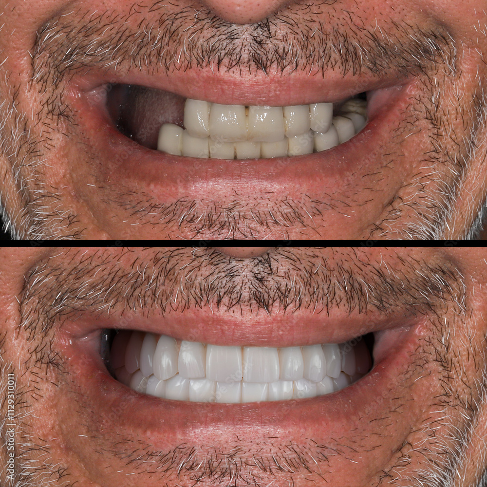 Full-arch dental prosthesis with the All on Four and All on X treatment ...