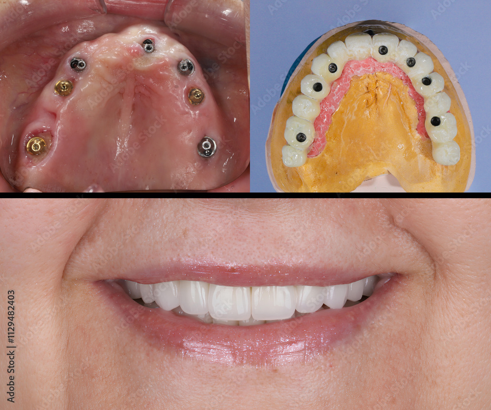 Full arch dental prosthesis supported by implants for an edentulous jaw ...