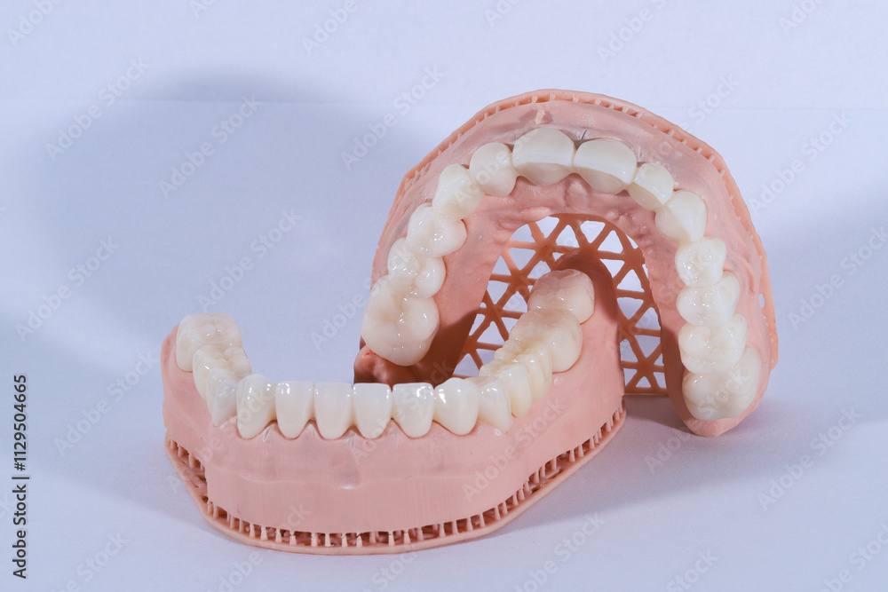 3D-printed jaw model and full-mouth zirconium porcelain crowns ...