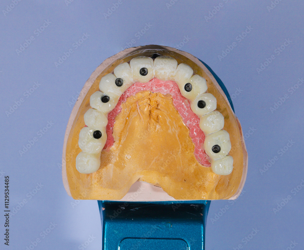 Full-arch dental prosthesis torque wrench and dental implant wrench ...