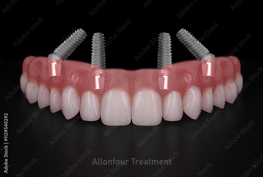 In dental implant surgery, the All-on-Four, All-on-4, and All-on-X ...