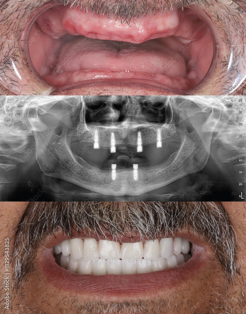 Foto de Stock Bone-integrated dental implant treatment with jaw surgery ...