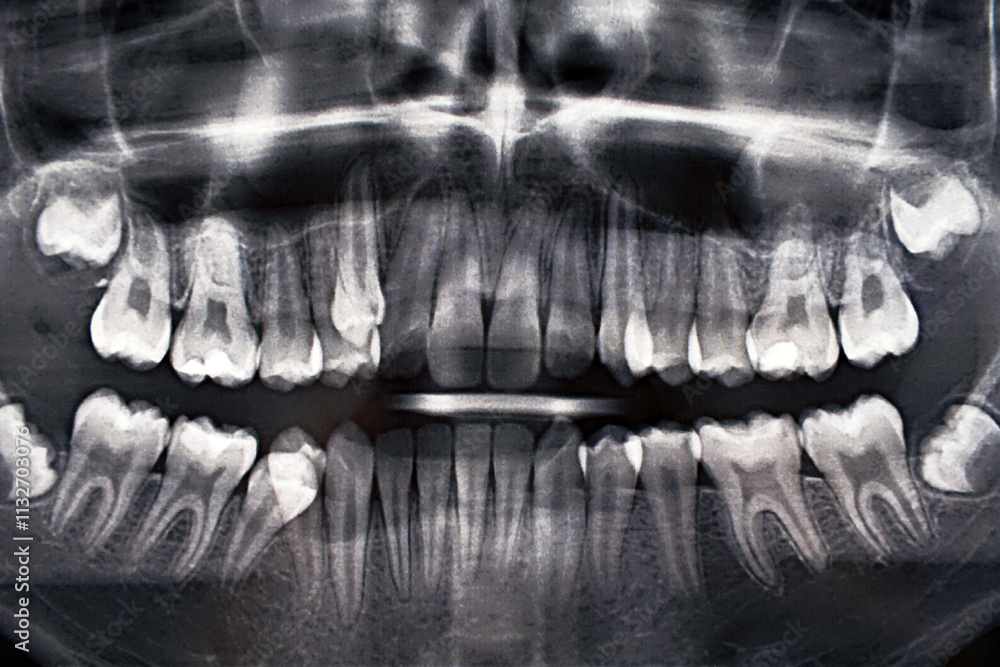 Dental x-ray and dentist tools, close-up. Panoramic x-ray radiograph of ...