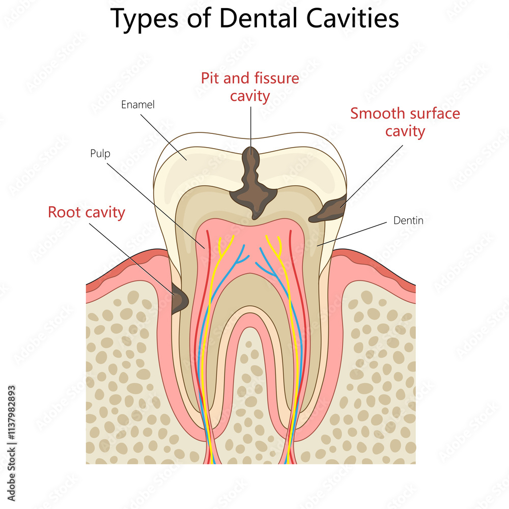 types of dental cavities. root cavity, pit and fissure cavity, and ...