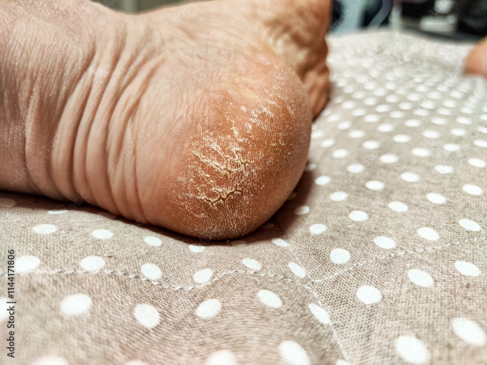 Sore cracked skin on the heel of the foot shows signs of fungal ...