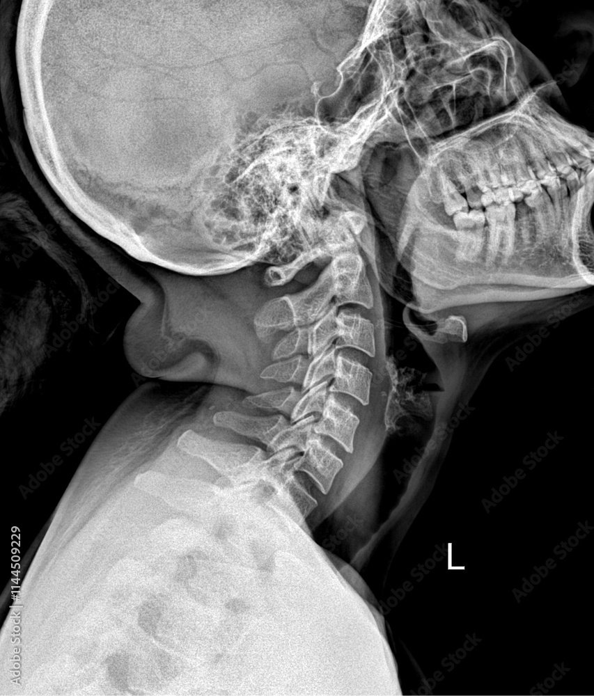 Neck Lateral X-Ray for Soft Tissue Assessment and Diagnostic Imaging ...