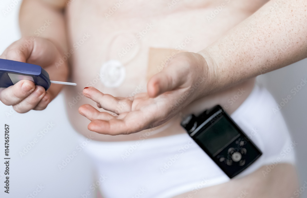Diabetes management at home, person using glucometer and insulin pump ...