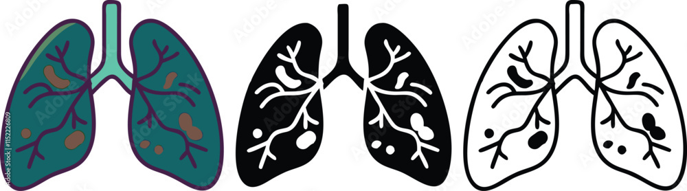 Diseased Lungs Illustrations of Pulmonary Infections, Bronchitis, and ...