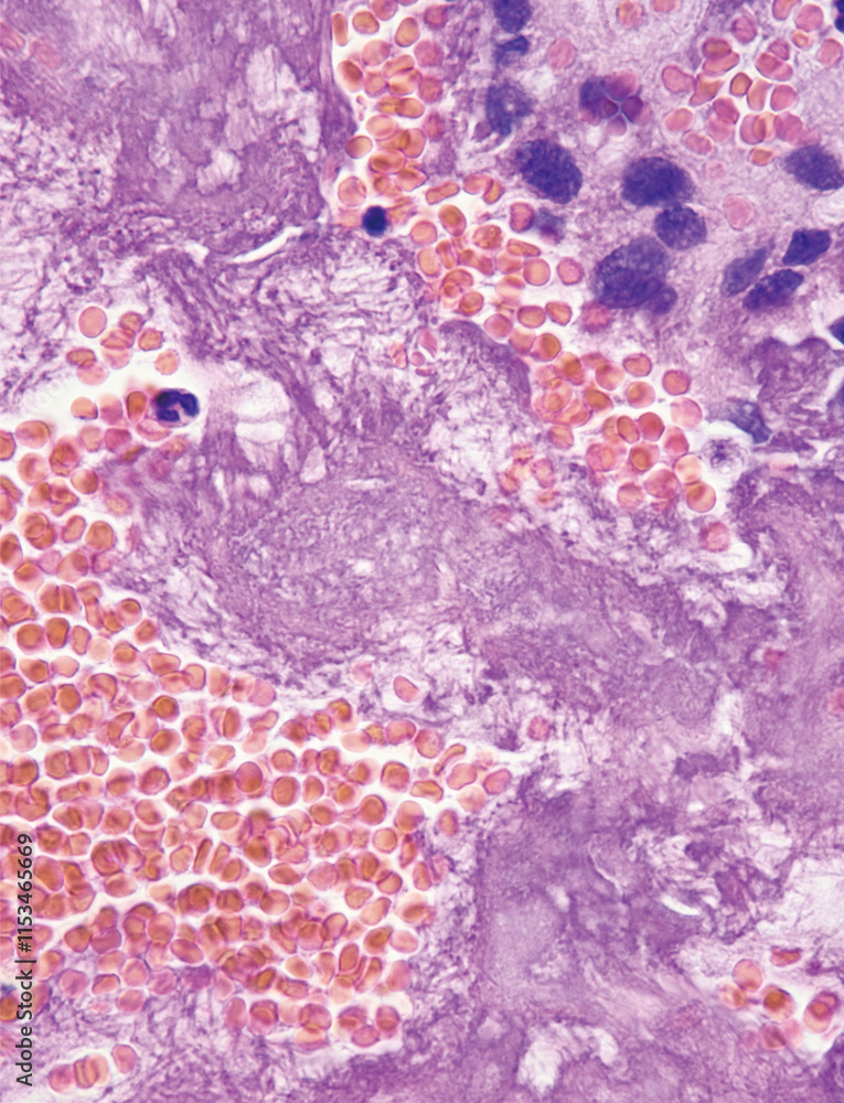 This photo shows the pink myxoid stroma of an atrial myxoma, with cords ...