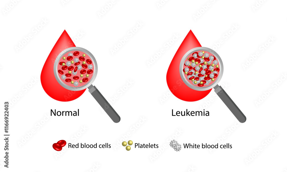 Leukemia, blood cancer. Difference between healthy normal blood and ...
