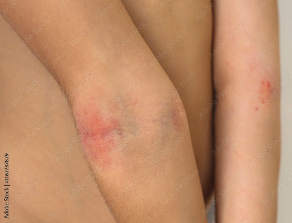 child shows her combed dry skin on the bend of her elbow, redness ...