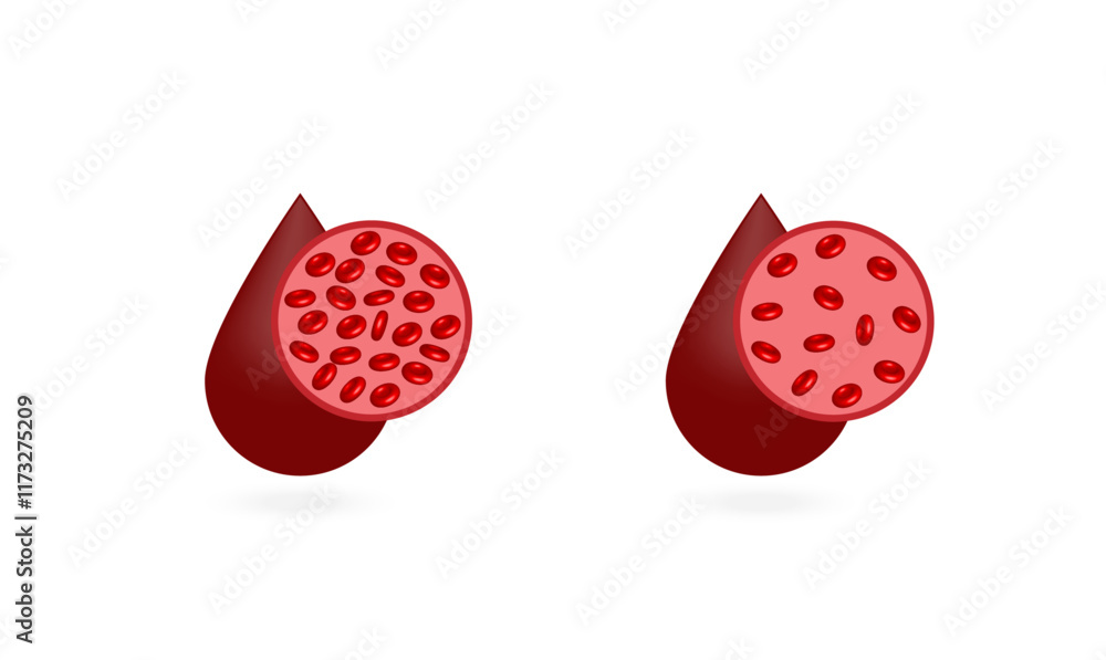 Iron deficiency anemia. Blood donation. Realistic vector 3d picture ...