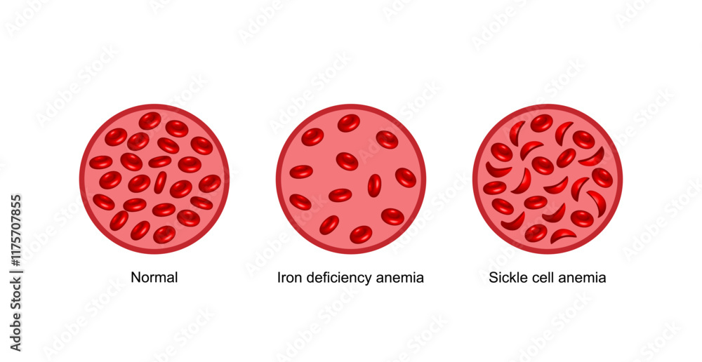 Iron deficiency anemia. Sickle cell anemia. Vector illustration ...