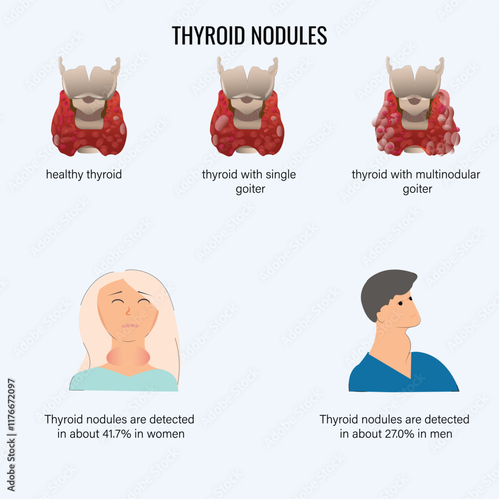 Thyroid Nodules and Nodular Goiter – Healthy, Single, and Multinodular ...