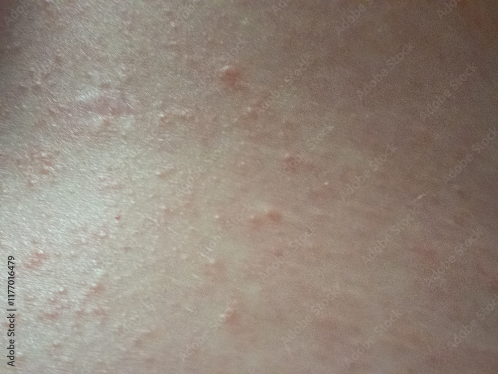 Untreated scabies rash on the skin of the Caucasian person Stock Photo ...