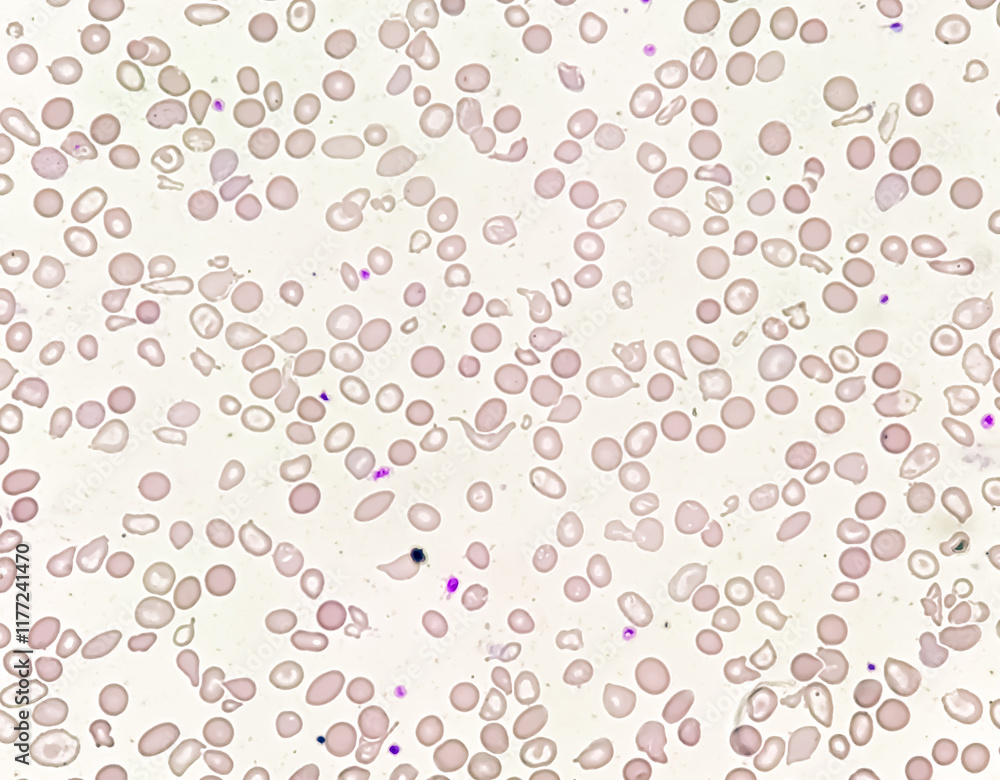 Hematological slide of Microscopic image showing severe microcytic ...