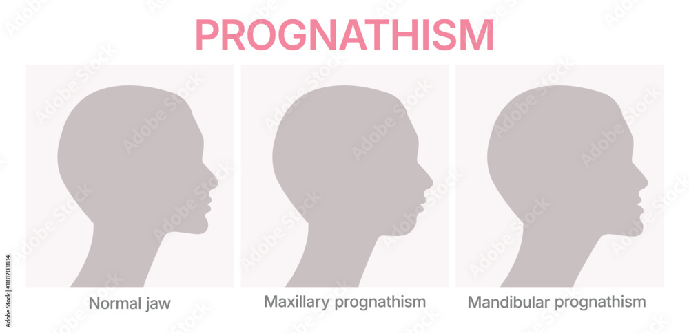 Vector illustration showing deformities of mandibular. Prognathism ...