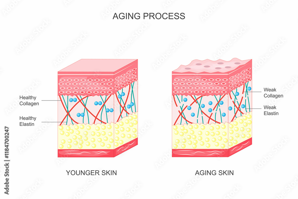 Diagram showing younger skin and aging skin.Aging process of skin ...